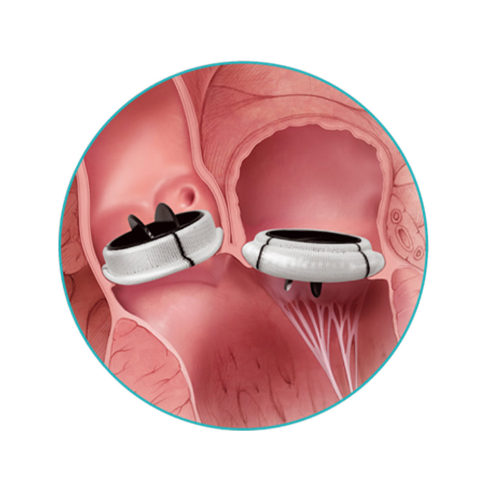 Prótesis Válvular Cardíaca – Arquimed
